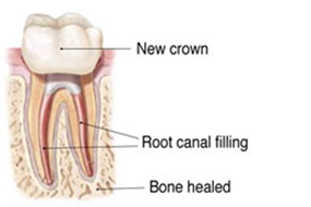 Root Canal Retreatment - Honolulu Endodontics | Endodontist in Honolulu, HI